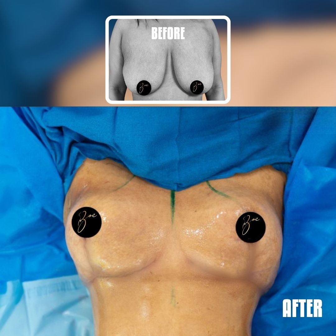 Breast Lift – Zoe Plastic Surgery